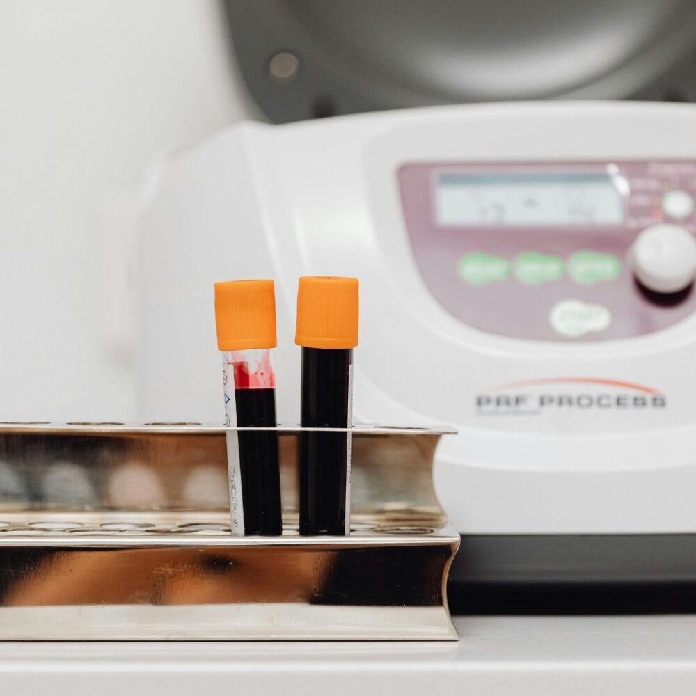 9 Must Have Blood Tests to Get if You’re Always Tired